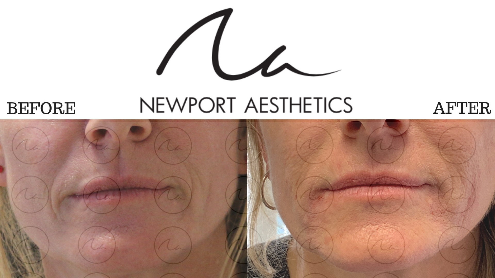 Versa | Newport Aesthetics